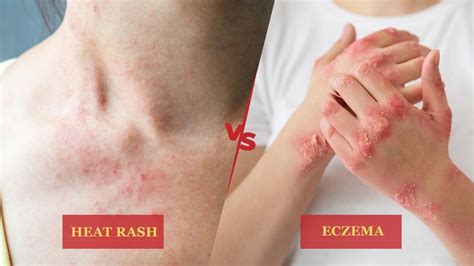 Heat Rash Vs Eczema Differences Causes And Treatment
