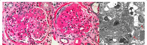 Light Microscopy Demonstrated A Moderate To Severe Mesangial Download Scientific Diagram