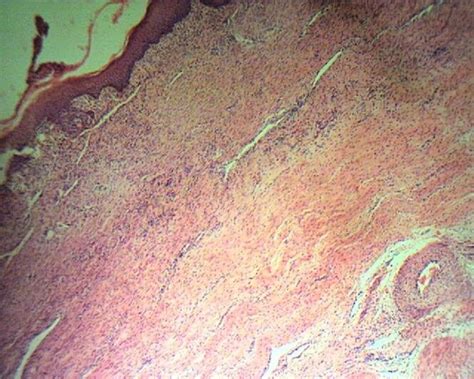 Tendon To Bone Junction Of Reattached Achilles Tendon To Calcaneal