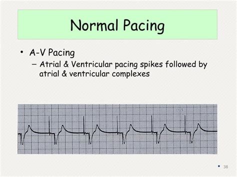 Temporary Pacemaker 2 Pptx Pptx