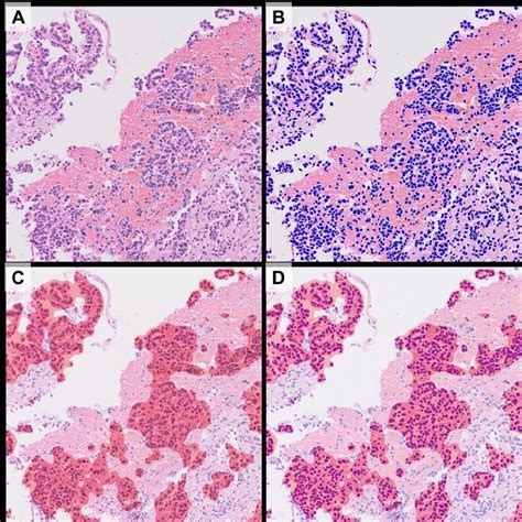 Calculation Of Tumor Cellularity Using Two Algorithms Original Hande Download Scientific Diagram