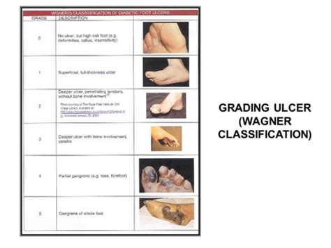 Diabetic Foot Ulcer Wagner Classification