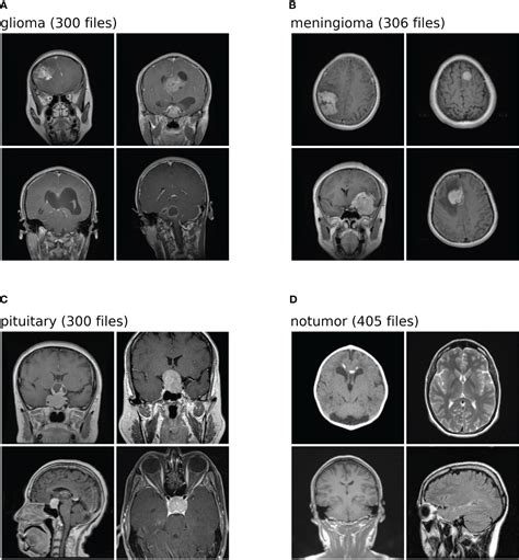 Frontiers A Fine Tuned Vision Transformer Based Enhanced Multi Class Brain Tumor