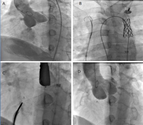 A Aortic Root Angiography In Left Anterior Oblique With Cranial