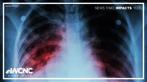 North Carolina Tuberculosis Cases On The Rise After 30 Years Of Decline