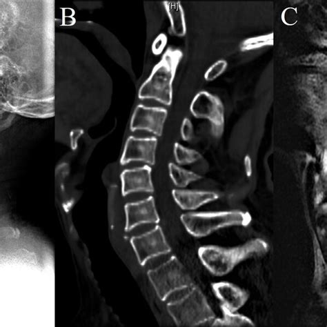 Castellvi Classification Of Transitional Lumbosacral Vertebra Tlv
