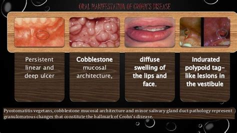 Oral Manifestations Of Gastrointestinal Disorders Ppt