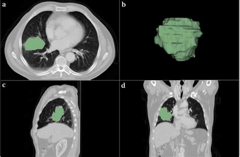 Semi Automatically Segmented Tumour Green Using 3d Slicer Axial Download Scientific