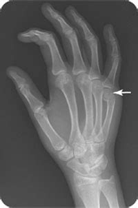 Boxers Fractures Radiology Key