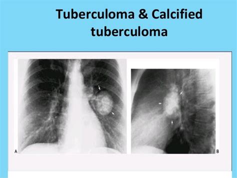 Pulmonary Tuberculoma
