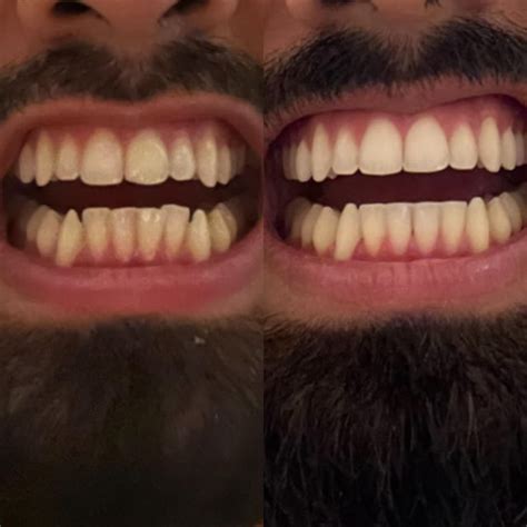 ~7 Months Fast Braces Rbraces