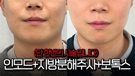 인모드 실제 후기남자ver Youtube