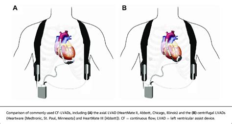 Types Of Continuous Flow Left Ventricular Assist Devices Download Scientific Diagram