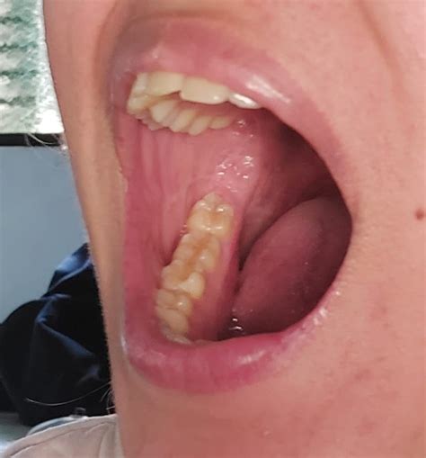 Fully Grown Wisdom Teeth Rteethporn