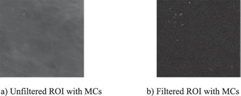 Detection And Classification Of Microcalcifications In Mammograms Images Using Difference Filter
