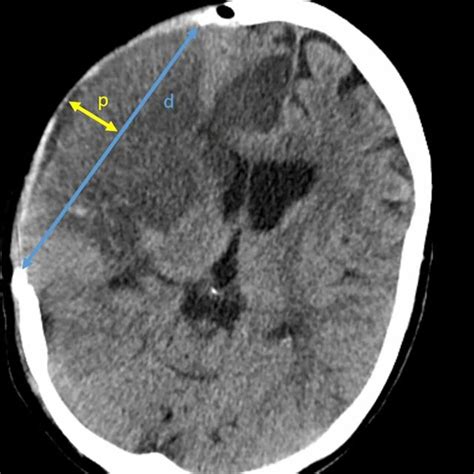 External Brain Herniation And Decompression Size Assessed On