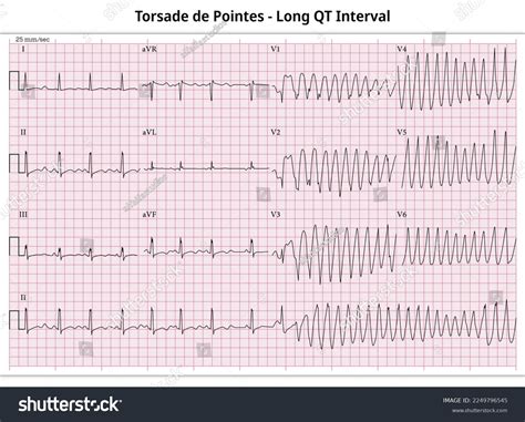 Ecg Torsade De Pointes Long Qt Stock Vector Royalty Free 2249796545