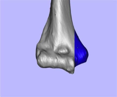 Medial Epicondyle Humerus
