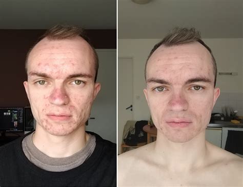 2 Weeks On Isotretinoin 10mg R Skincare Addiction