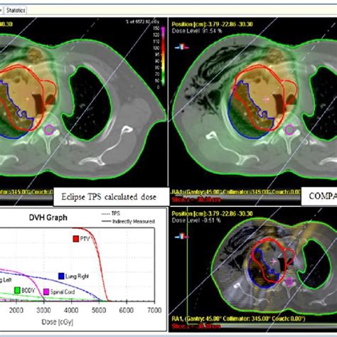 Dose Distribuon And Dvh Comparison Between Eclipse Tps Calculated And Download Scientific
