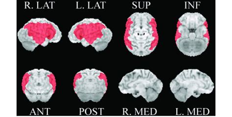 Cortical Surface Map Of The Mca Territory Superimposed On Neurostat T
