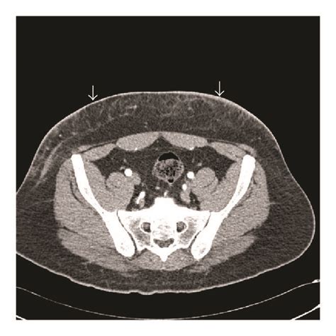 A Ct Abdomen Coronal View Showing Inflamed Appendix Red Arrow