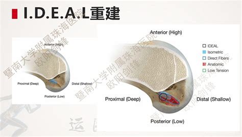 临床技术 四字位辅助内侧入路前交叉韧带单束重建技术 骨科在线