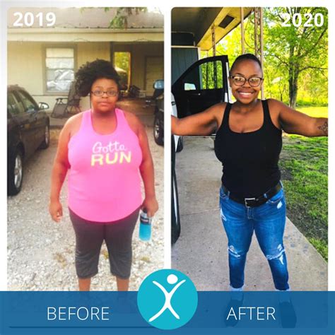 Gastric Sleeve Results Before And After