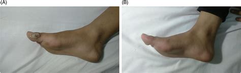 A Verruca Vulgaris Over Medial Aspect Of The Right Great Toe B Download Scientific Diagram