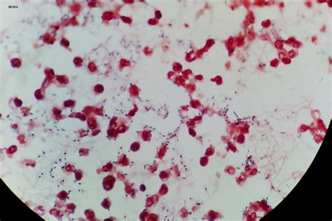 Apa Sebenarnya Penyakit Pneumokokus Fabfit Tips Untuk Hidup Sehat