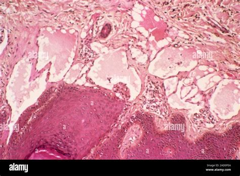 Lymphangioma Light Micrograph Of A Section Through A Lymphangioma From A Lymph Vessel