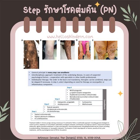 Update And Management ตุ่มคัน Prurigo Nodularis 2022 Hello Skin By