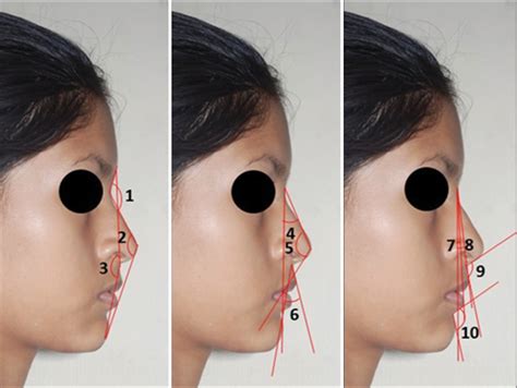 Photogrammetric Angular Measurements As A Diagnostic Tool For Orthodontic Treatment Planning