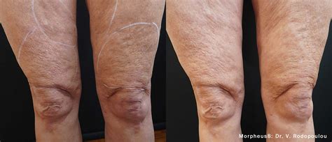 Morpheus8 Cost Info Ba Gallery Medspa Sherman Oaks