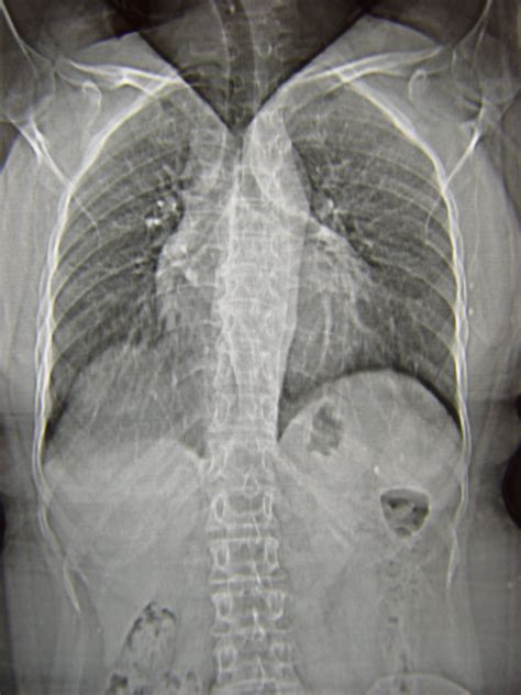 Scleroderma In Lungs Life Expectancy