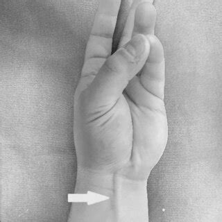 Schaeffers Test Presence Of Palmaris Longus Tendon White Arrow