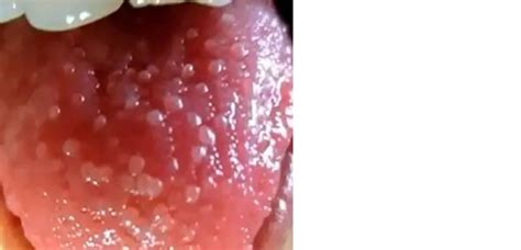 Lingual Papillitis