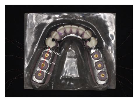 Model Of Mandibular Kennedy Class I Bilateral Distal Extension Missing Download Scientific