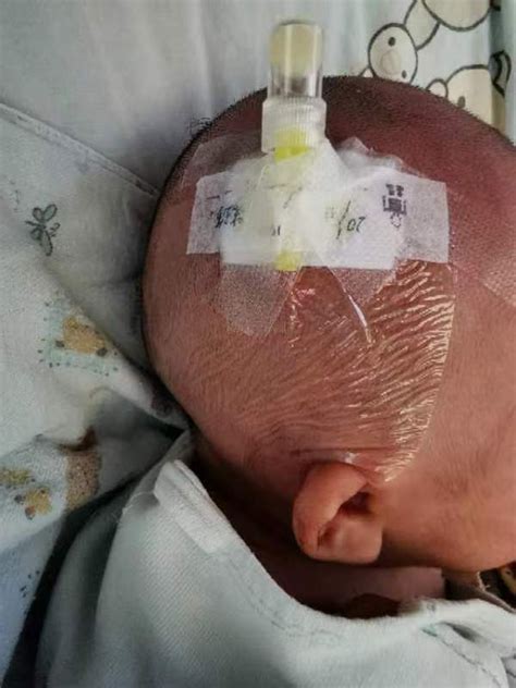 Scalp Indwelling Needle Puncture And Fixation In The Right Superficial Download Scientific