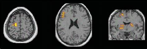 Activation Correlating Positively With Subjective Anxiety Scores During
