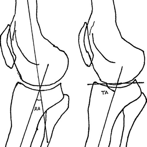 A The Recurvatum Angle Ra And B Tibial Plateau Angle Ta Download Scientific Diagram