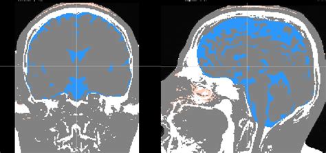 cat12 tissue segmentation error bugs brainstorm