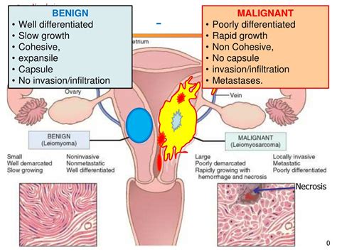 Ppt Pathology Lecture Neoplasia Powerpoint Presentation Free