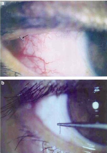 A Slit Lamp Photo Of The Right Eye Showing Cilium Protruding Through