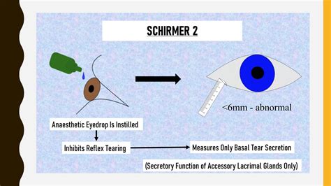 Dry Eye Causes Aetiology Pathogenesis Treatmentpptx