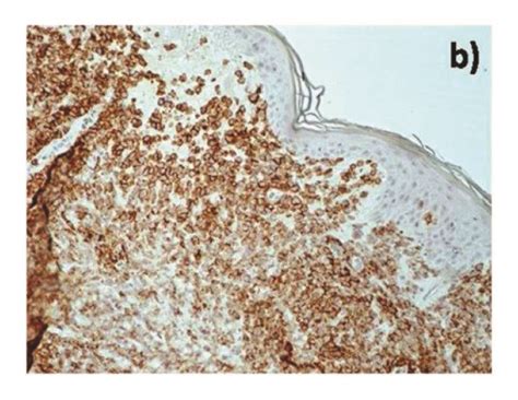 A Diffuse Infiltration Of The Dermis By Large Lymphoid Tumor Cells Download Scientific