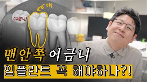 맨 안쪽 어금니 임플란트 꼭 해야 하나요 큰 어금니 하나로 안 되나요 Youtube
