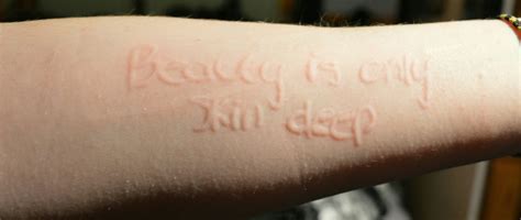 Dermatographia Causes Symptoms Diet Prognosis Treatment