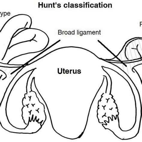 Hunts Classification Divides The Disease Into Fenestra And Pouch Types