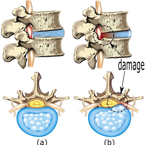 A Healthy Functional Spinal Unit B Detailed View Of The Nerve